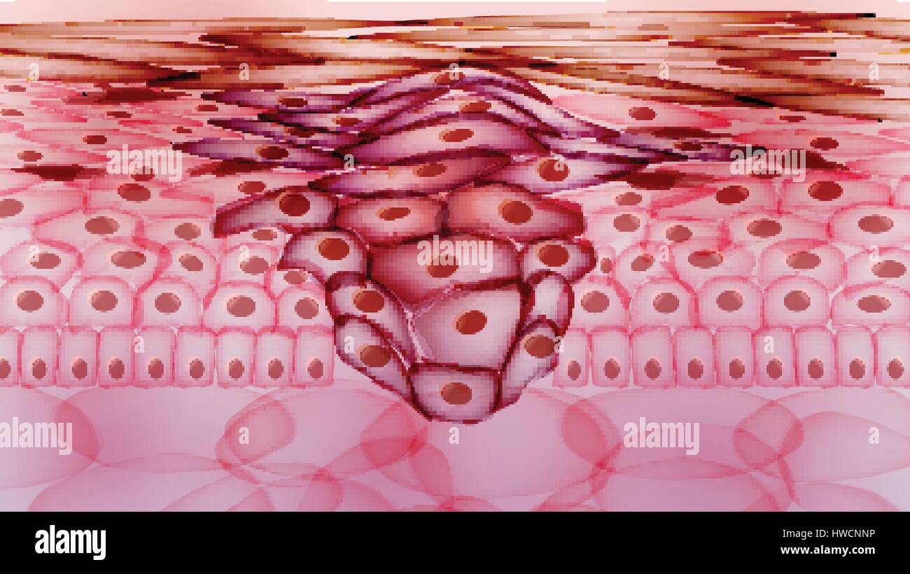 Growing Tumor, Tissue Section Inflamed Skin - Vector Illustration Stock ...