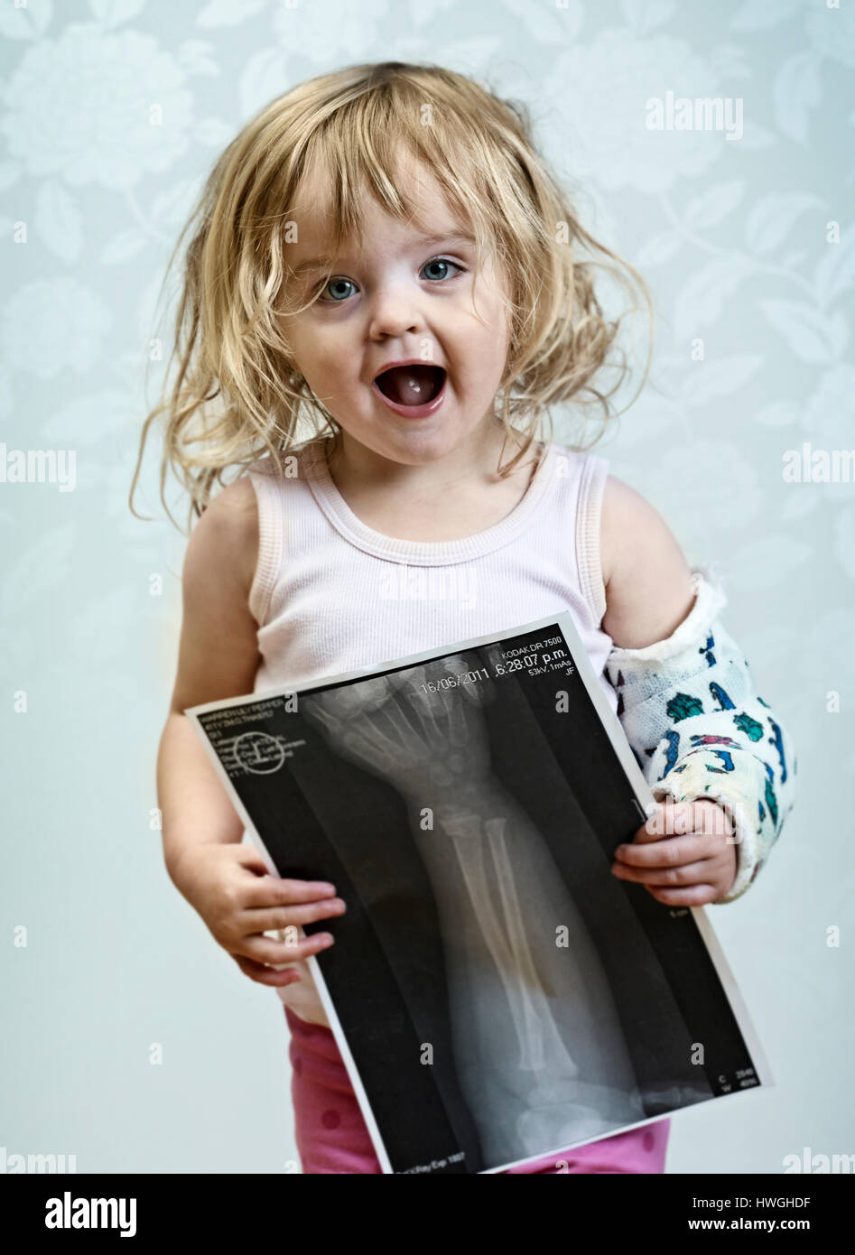 child holding X ray with broken arm in cast Stock Photo - Alamy