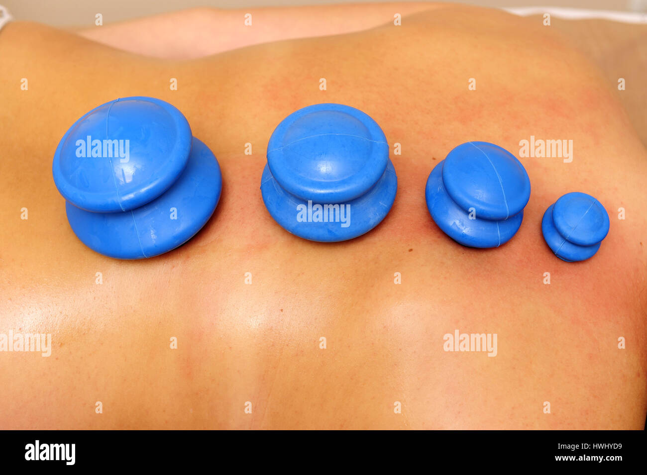 health, back, body, cupping, negative pressure, getting rid of toxins ...