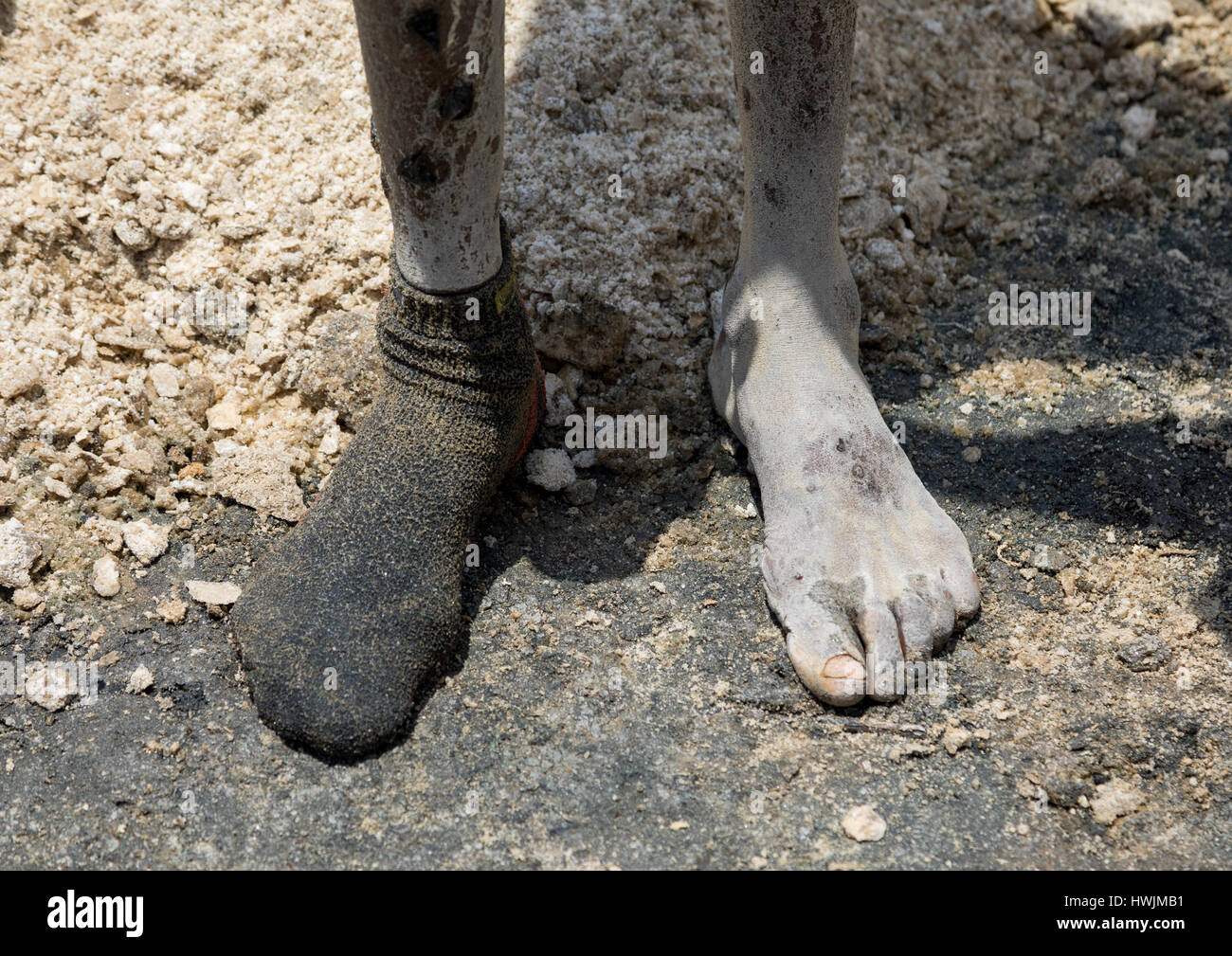 Borana tribe man feet wounded after diving in the volcano crater to ...
