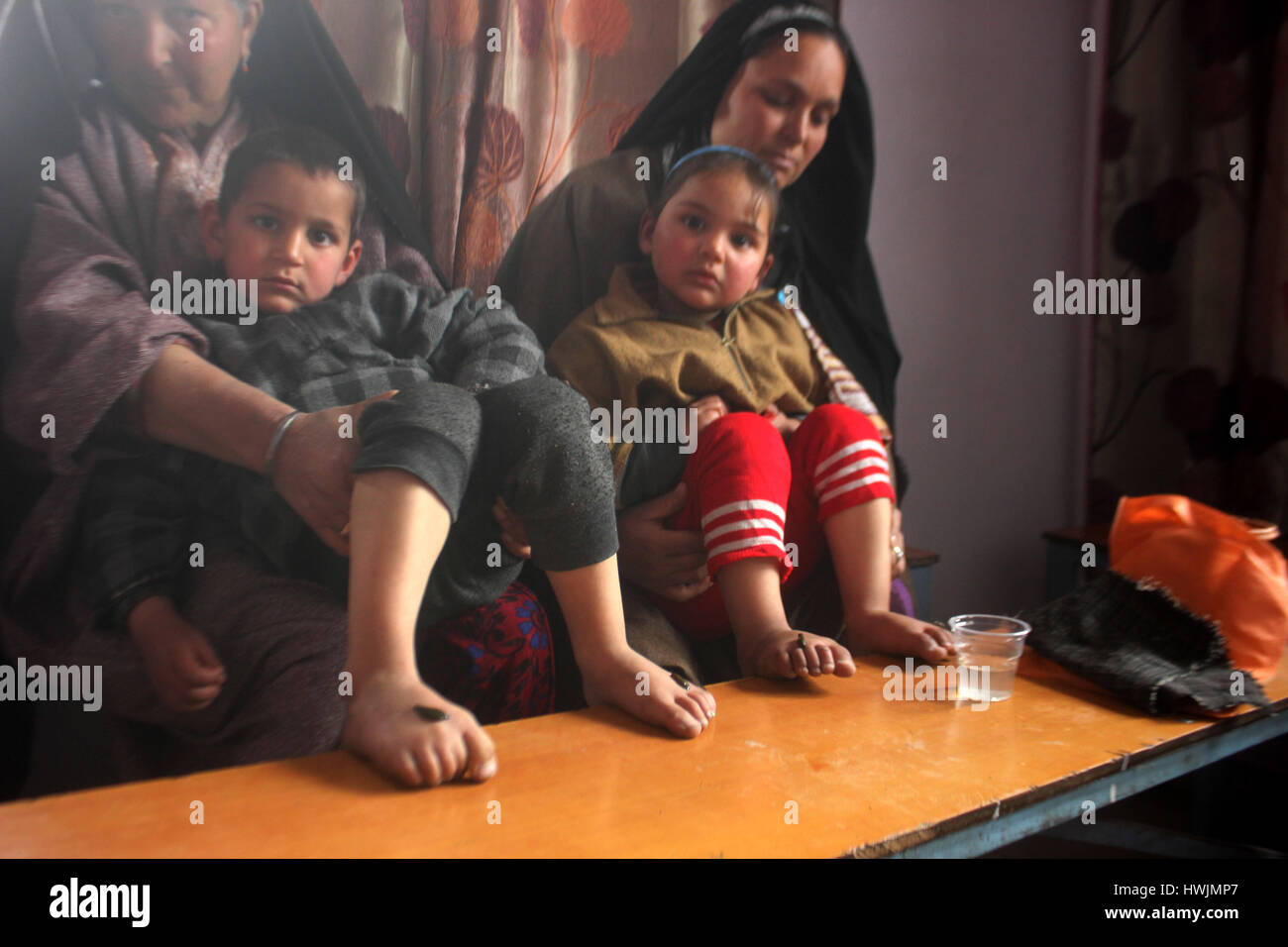 A Young Kashmiri children's receives leech therapy on his feet on March ...
