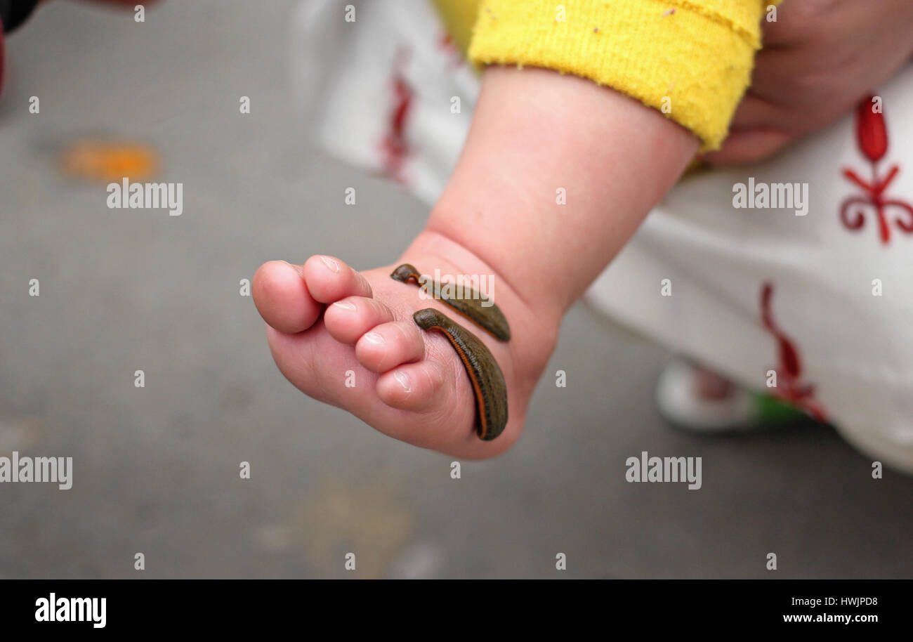 Leech sucks impure blood from a foot of a child in Hazratbal Srinagar ...