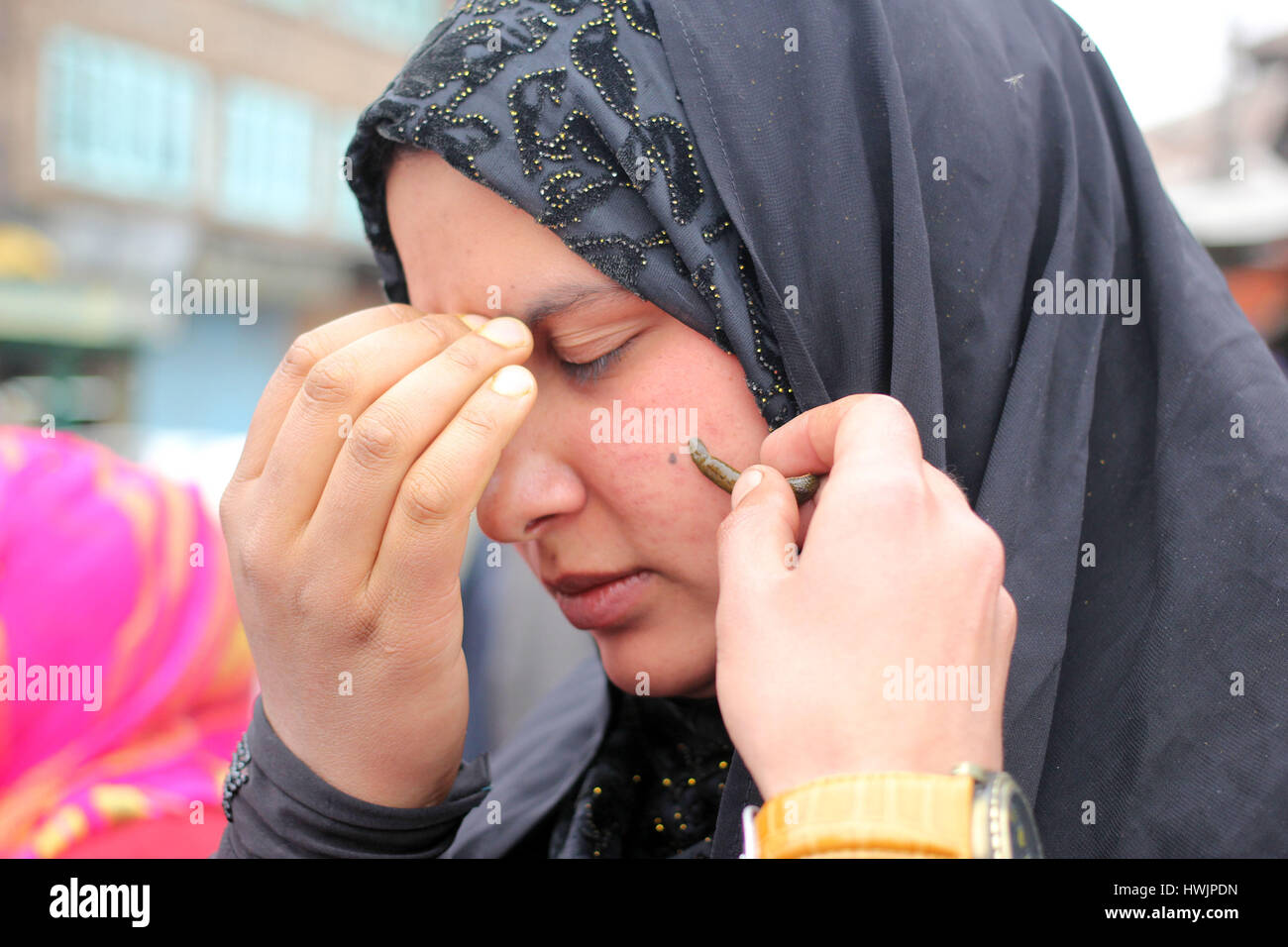 A Kashmiri girl receives leech therapy on Tuesday, March 21, 2017 ...