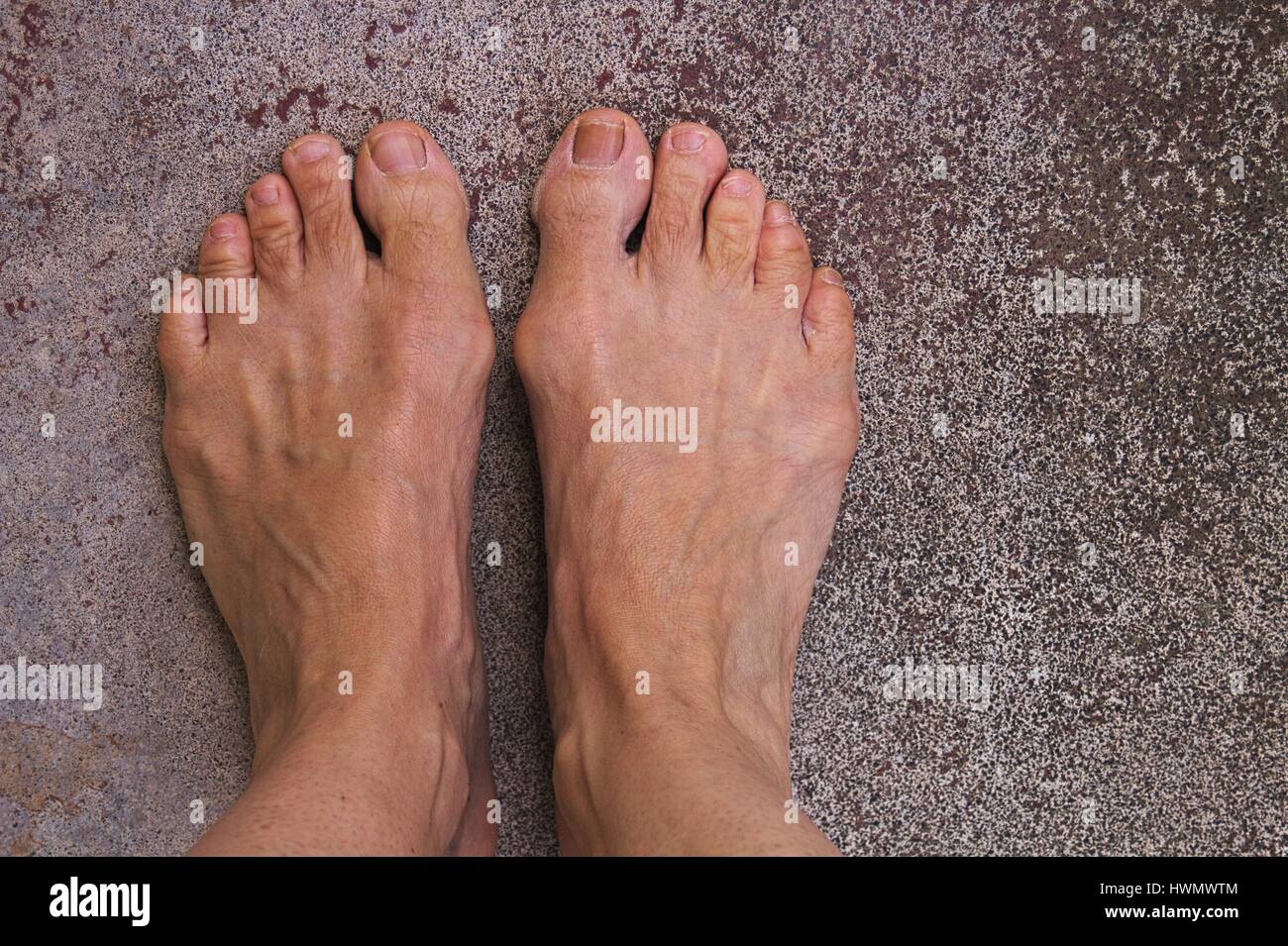 Bare feet showing the deformity hallux valgus or bunions Stock Photo ...