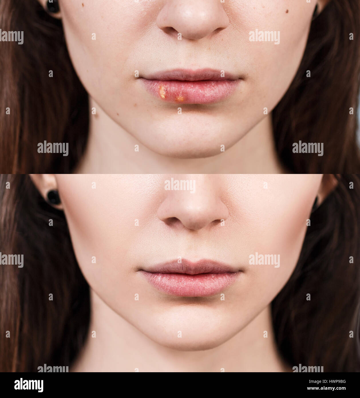 Sore on the female lips before and after treatment Stock Photo - Alamy