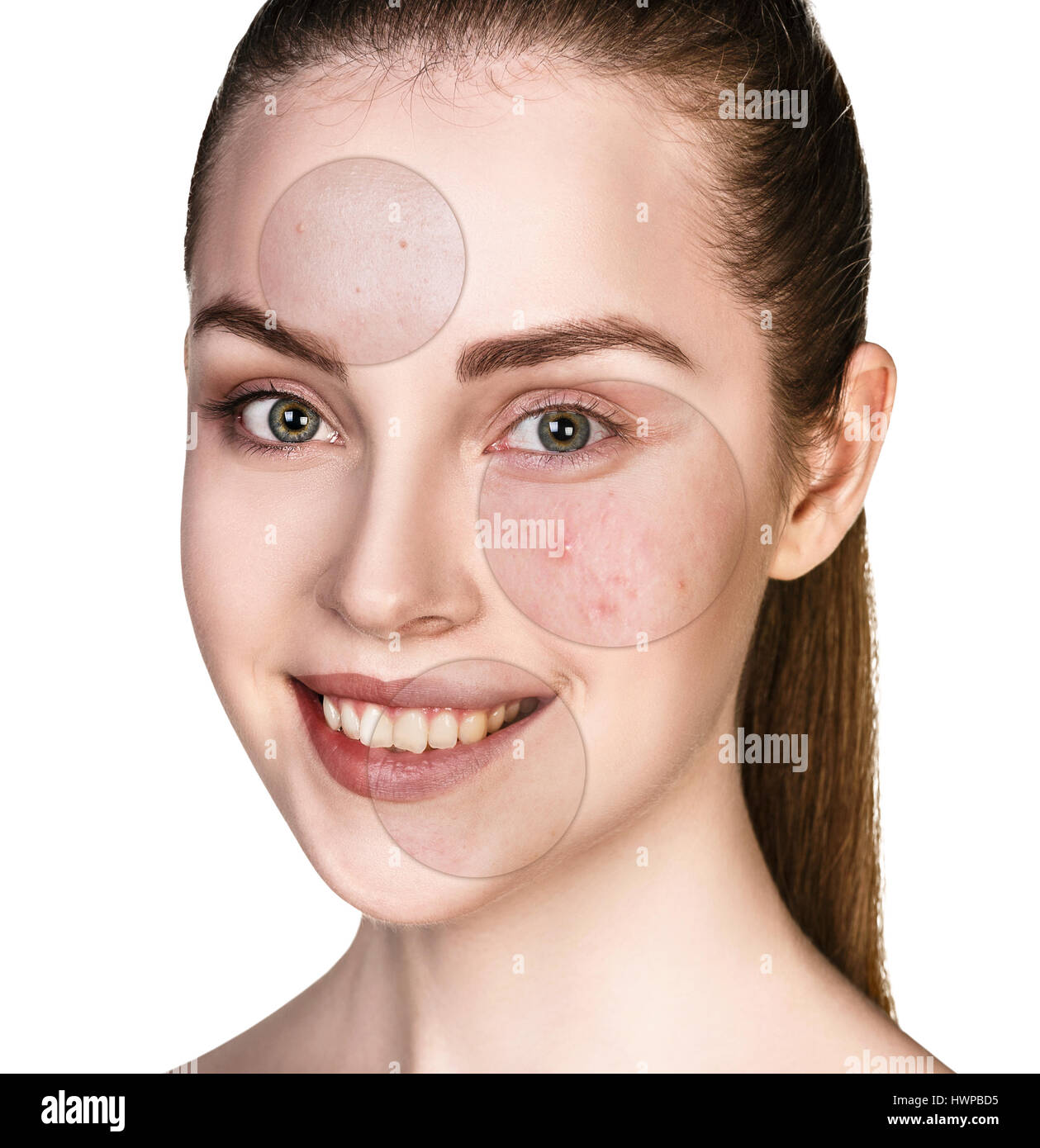 Teen skin problem hi-res stock photography and images - Alamy