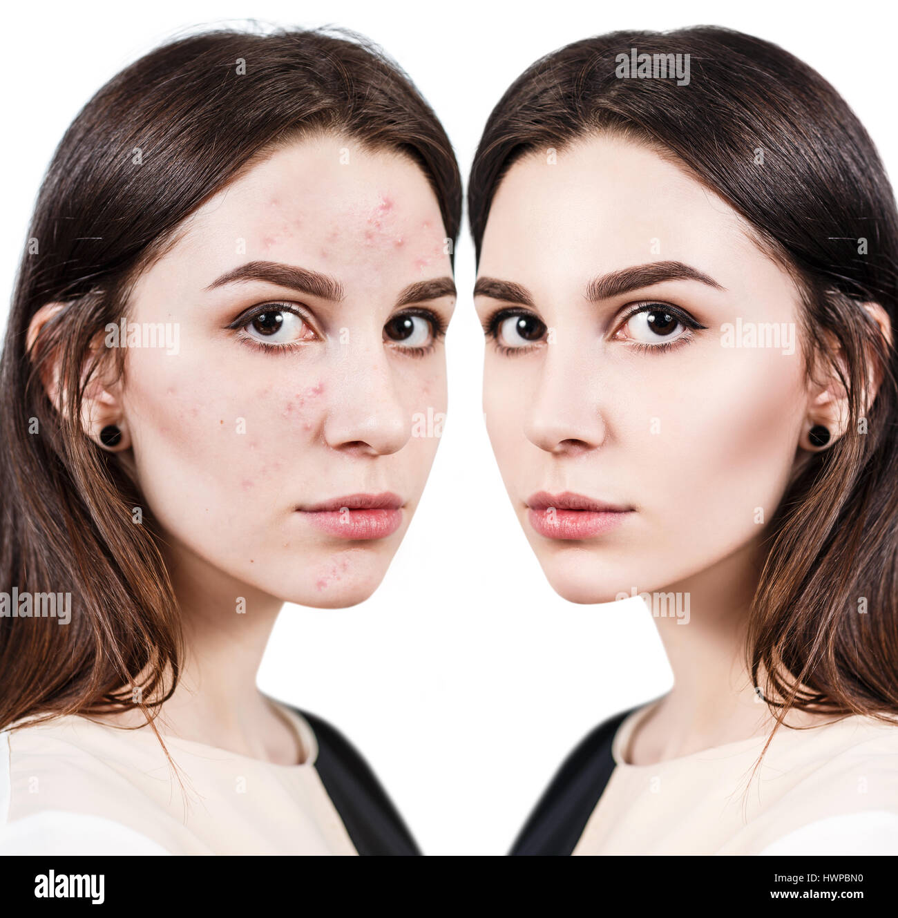 Woman with problem skin on her face before and after treatment over ...