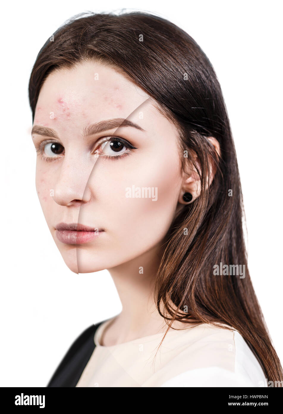 Comparison portrait of young girl with problematic skin before and ...