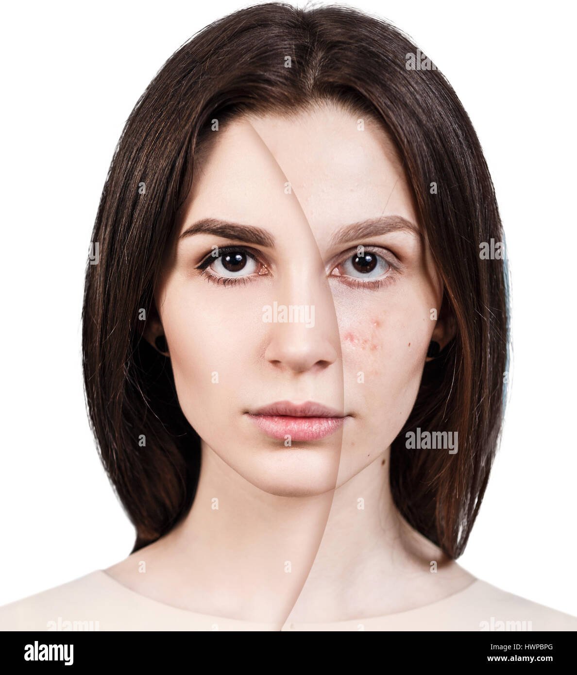 Half face of young girl with problematic skin before and after ...