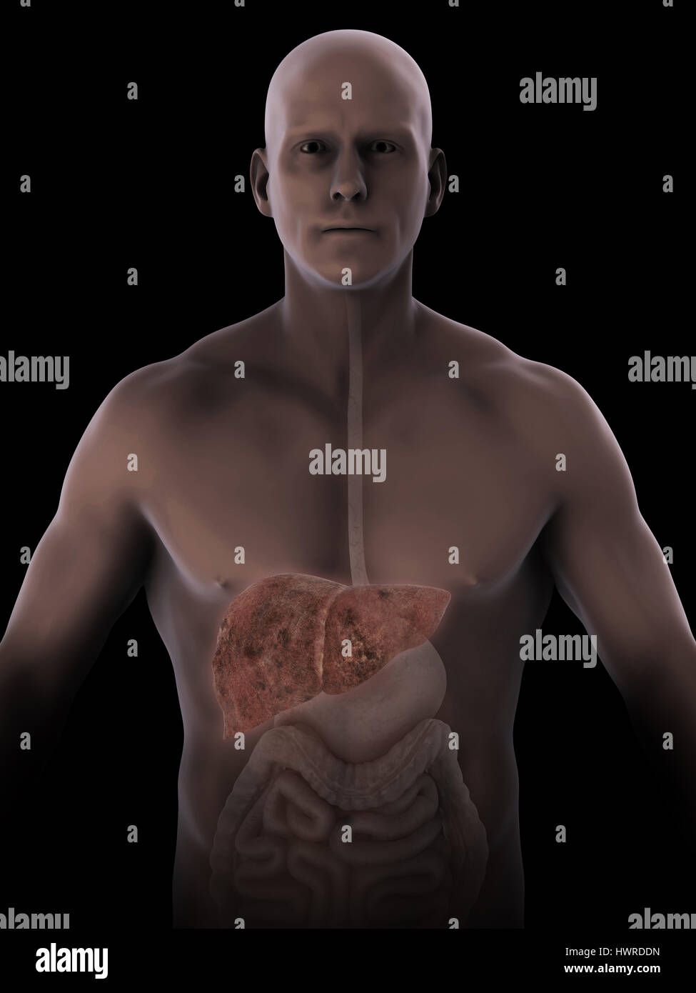 Unhealthy Liver Anatomy Stock Photo - Alamy
