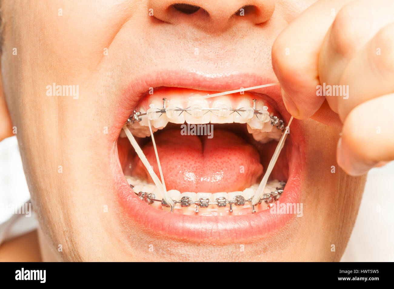 Rubber strings for teeth correction with braces Stock Photo - Alamy