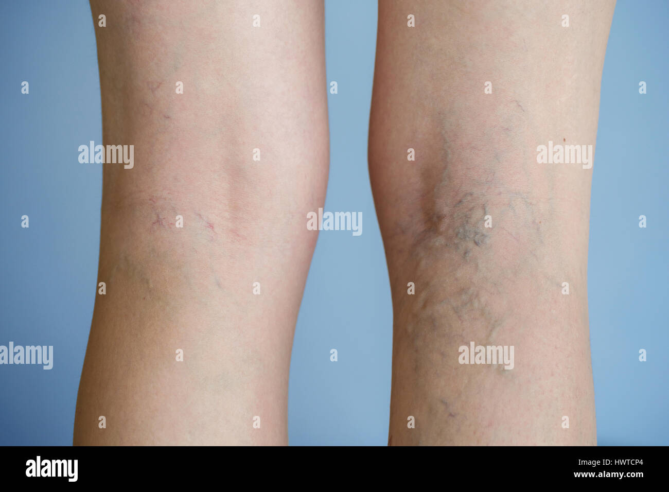 Painful varicose veins (spider veins, varices) on a severely affected ...