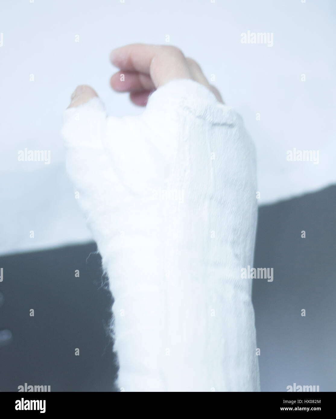 Doctor applying a plaster cast and bandages to patient forearm and ...