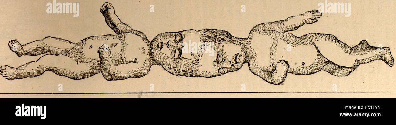 The Craniopagus twins are a rare condition where conjoined twins are ...