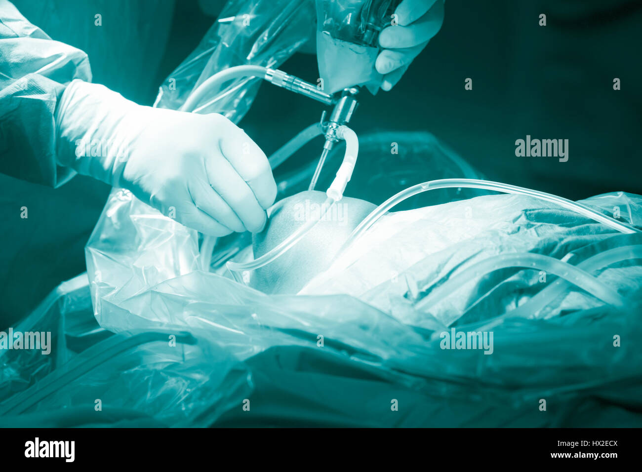 Knee keyhole surgery hospital arthroscopy operation medical procedure ...