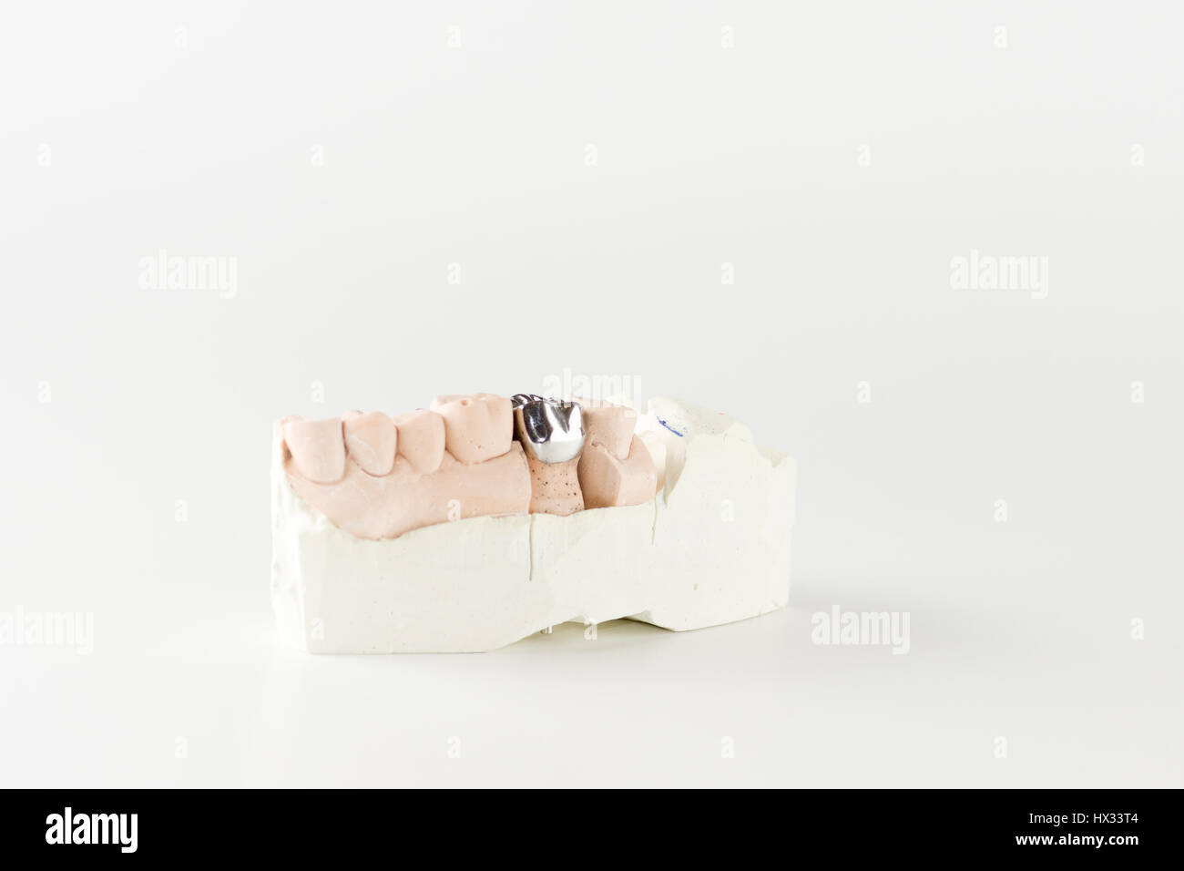 cast metal dental crown on artificial plaster model Stock Photo - Alamy