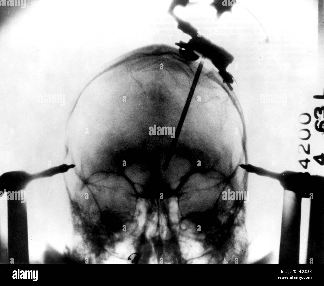An X-ray photograph that shows a detector probe placed in a patient ...