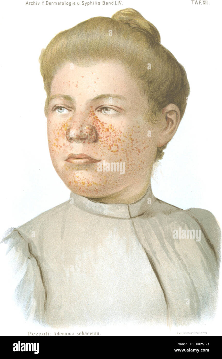 Tuberous sclerosis is a genetic disorder characterized by the growth of ...