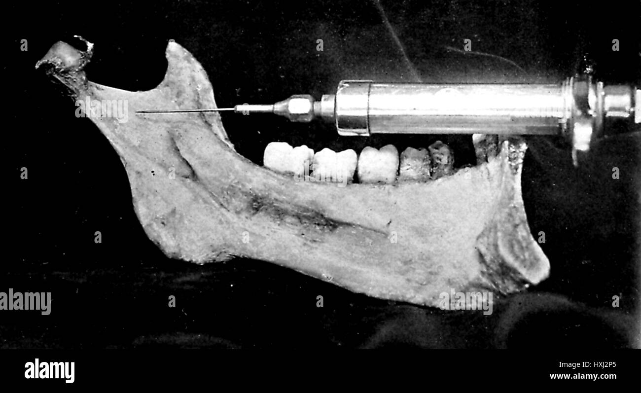 Still life illustration featuring a syringe penetrating into the jaw of ...