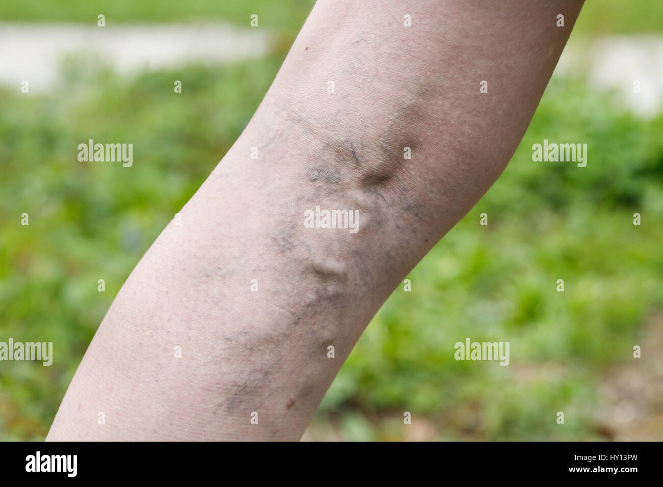 Woman with painful varicose and spider veins on her legs. Vascular ...