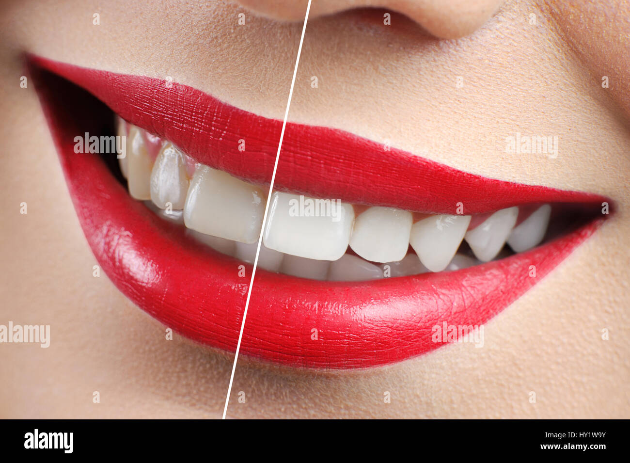 Before and after shot of red lipped woman teeth whitening Stock Photo ...