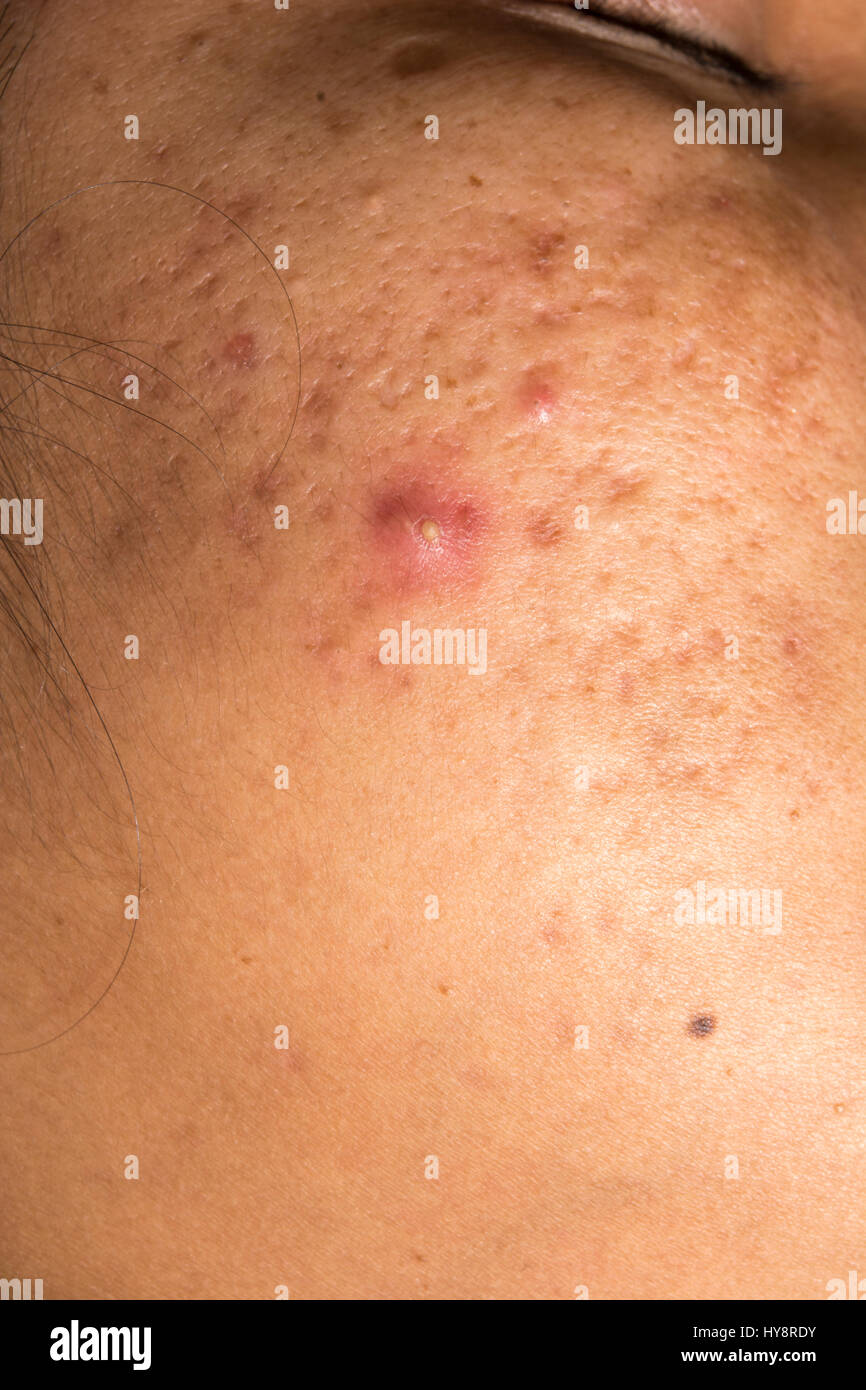 close-up for acne on women face Stock Photo - Alamy