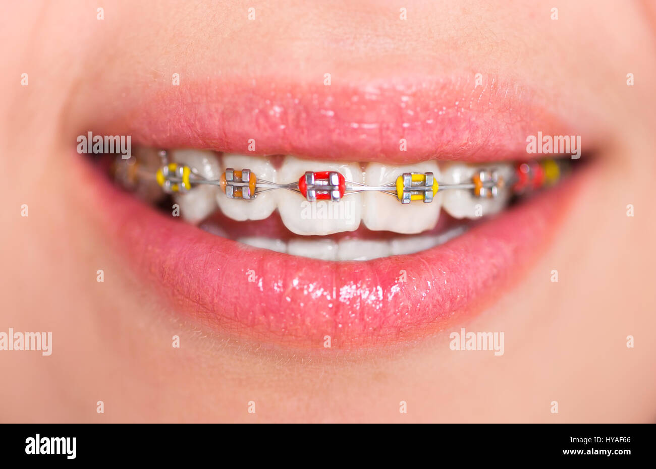 Multi-colored bracket system. Dental concept. close-up shot Stock Photo ...