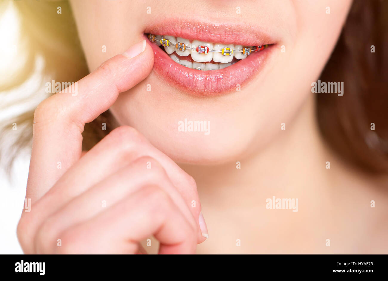 Studio portrait of a girl with multi-colored braces. Isolated on white ...