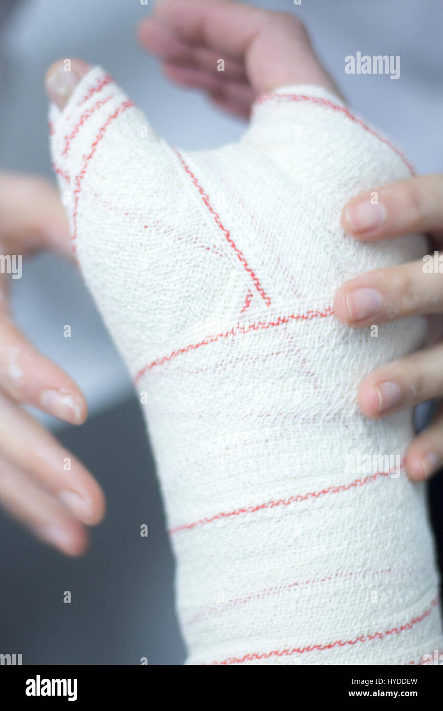 Doctor applying a plaster cast and bandages to patient forearm and ...