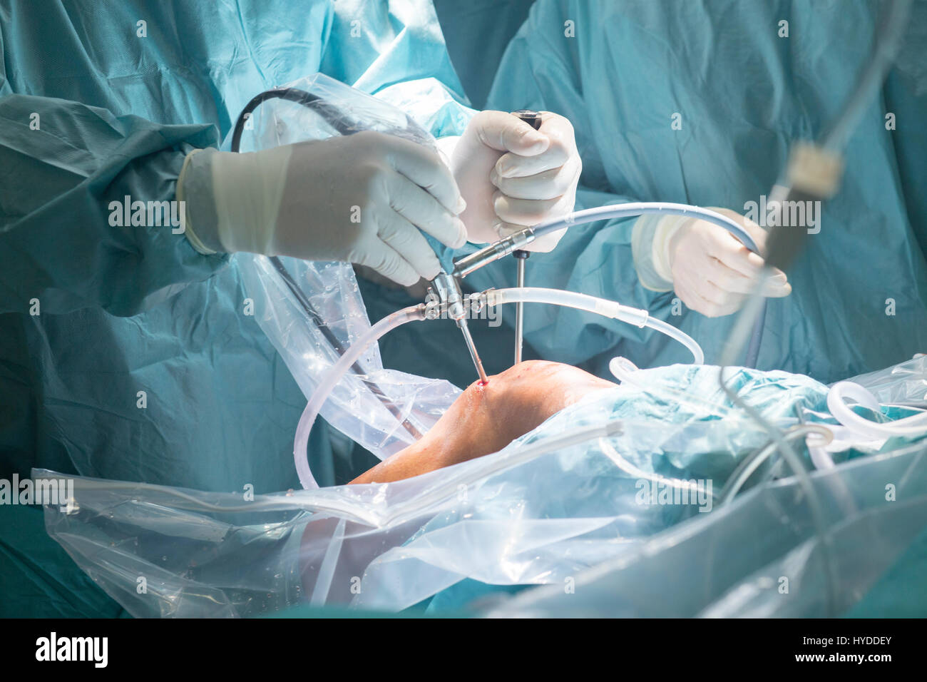 Knee keyhole surgery hospital arthroscopy operation medical procedure ...