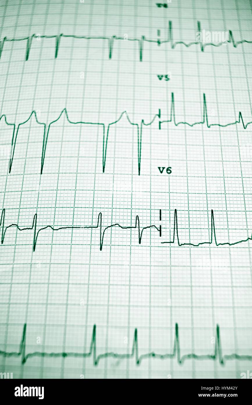 Close up of an electrocardiogram in paper form Stock Photo - Alamy