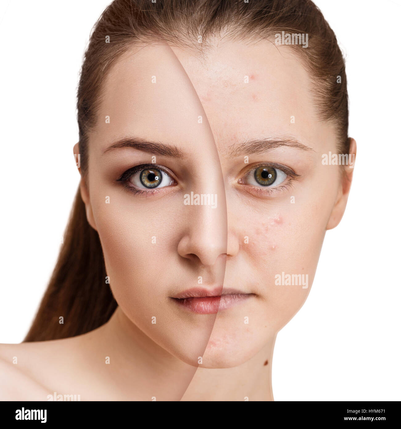 Girl with acne before and after treatment Stock Photo - Alamy