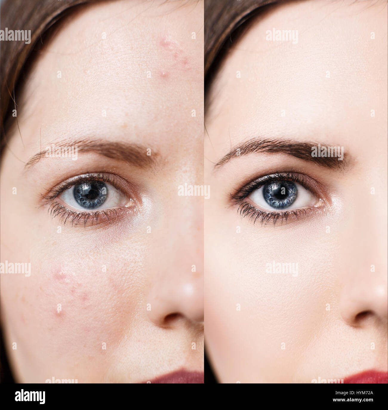 Woman with problem skin on her face Stock Photo - Alamy