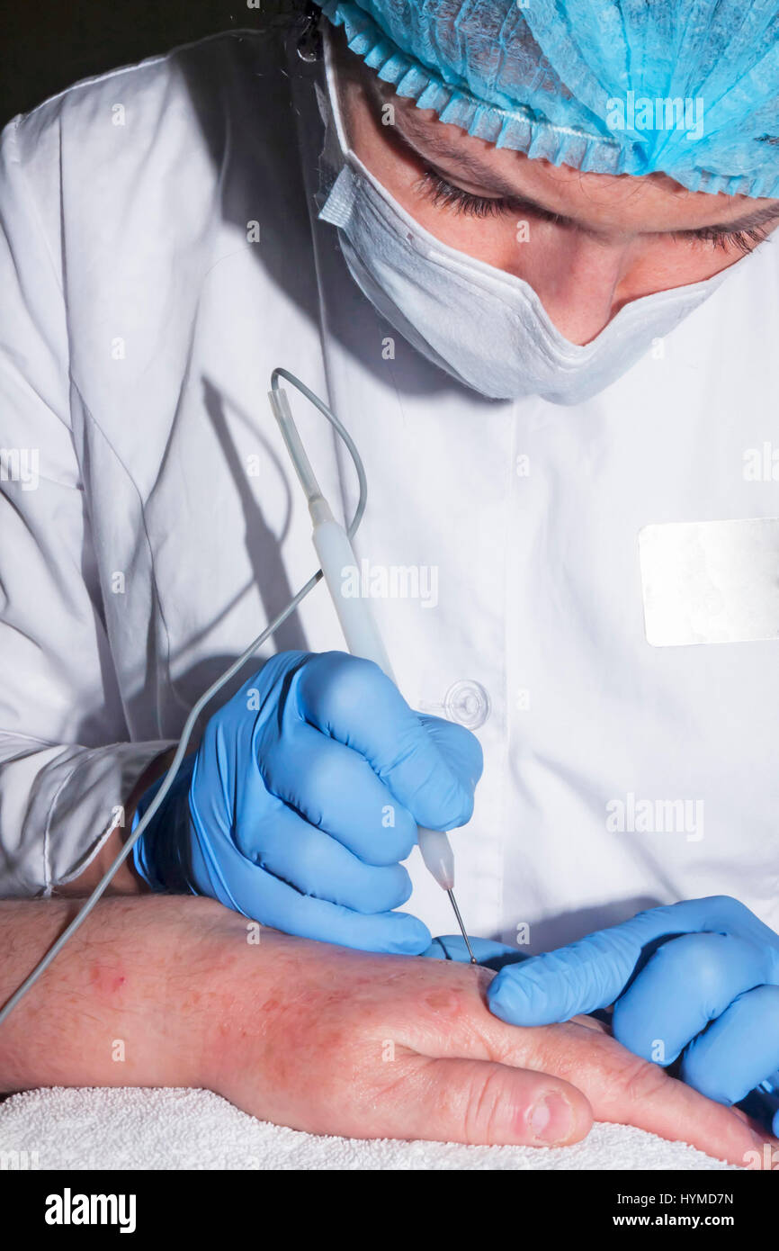 Microsurgery: Dermatologist surgeon removes skin disease Stock Photo ...