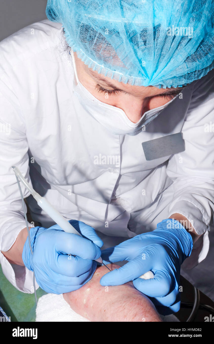 Microsurgery : Dermatologist surgeon removes skin diseases Stock Photo ...