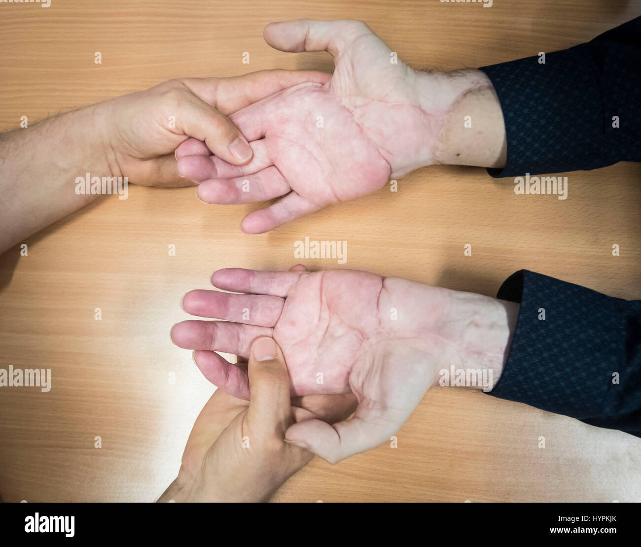 The hands of the UK's first double hand transplant patient Chris King ...