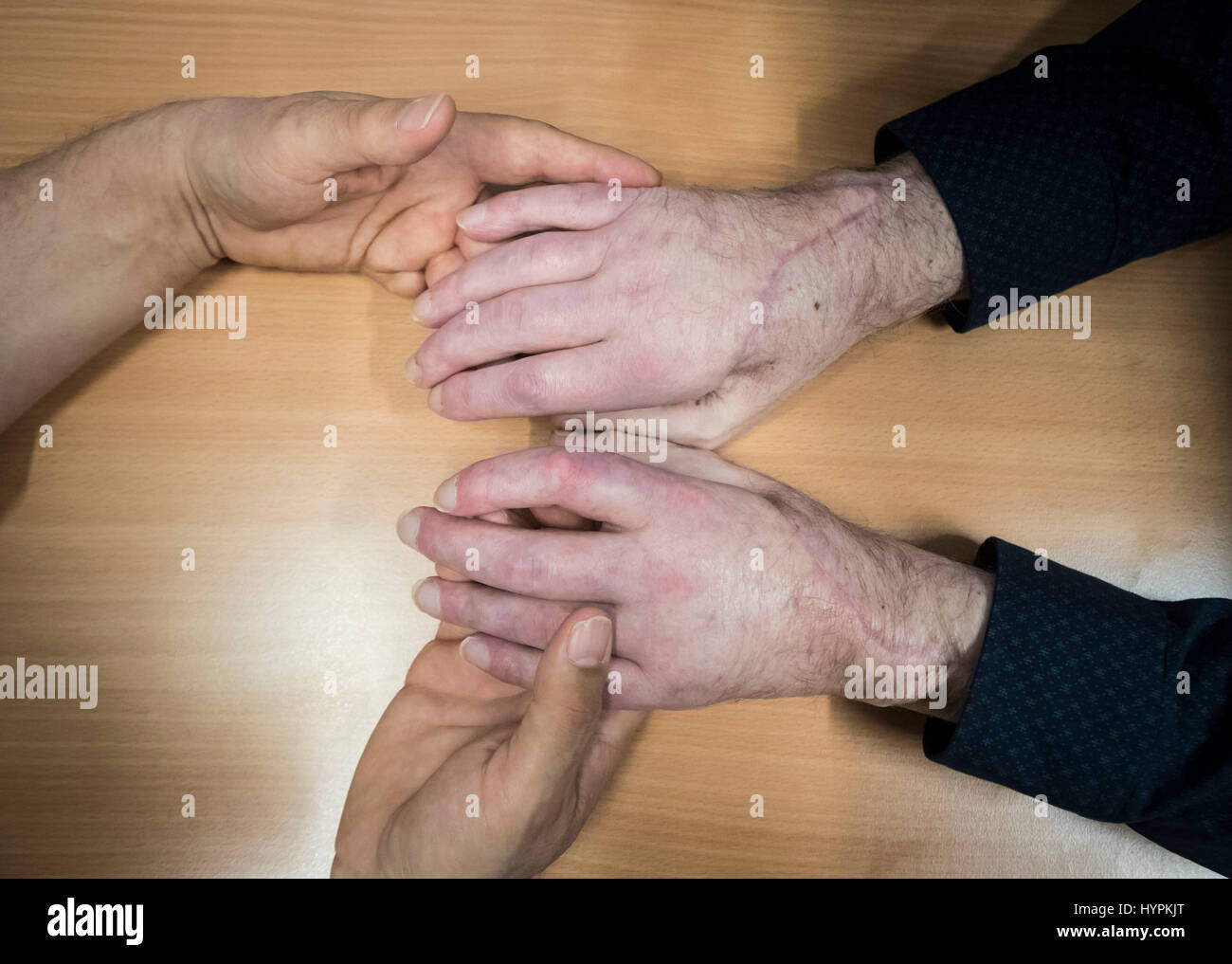 The hands of the UK's first double hand transplant patient Chris King ...