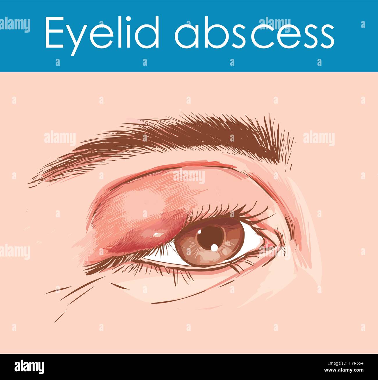 Meibomian abscess Stock Vector Images - Alamy