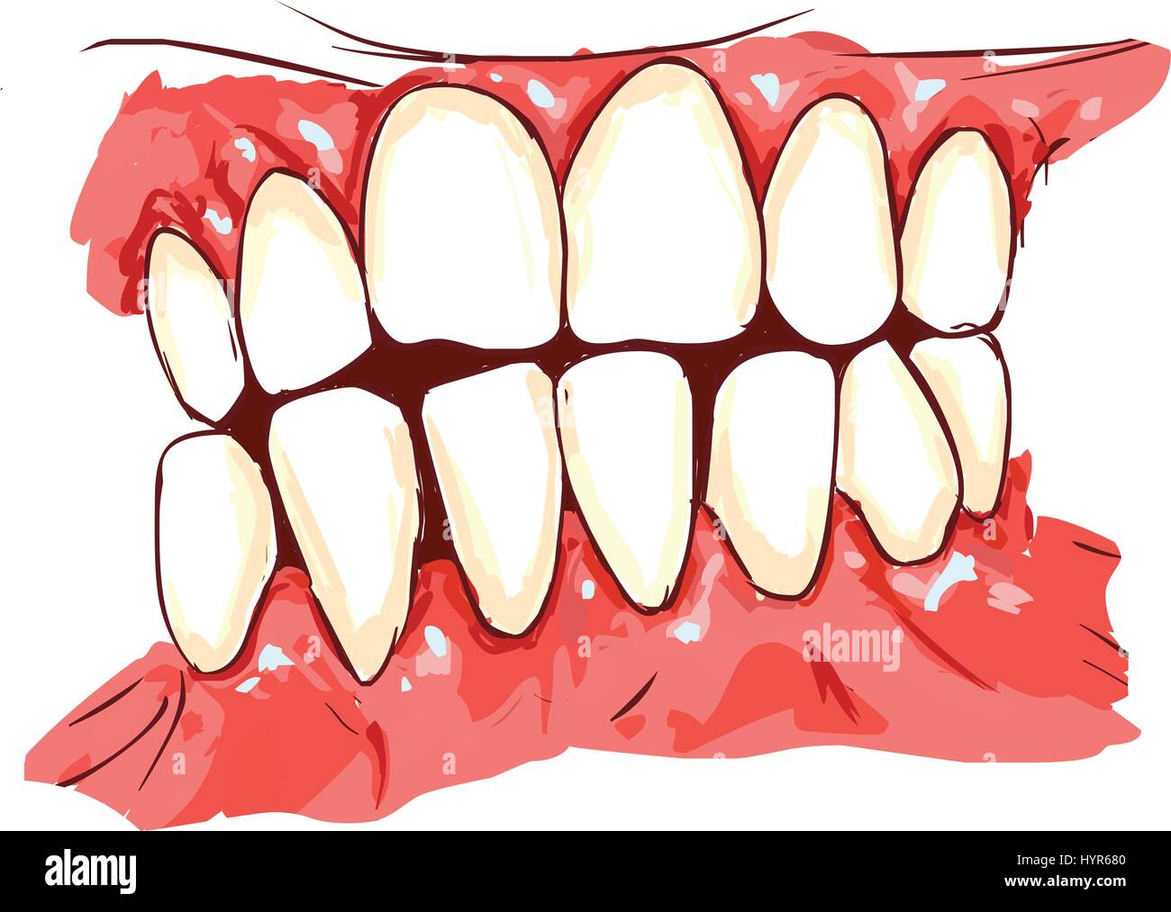 Gum disease hi-res stock photography and images - Alamy