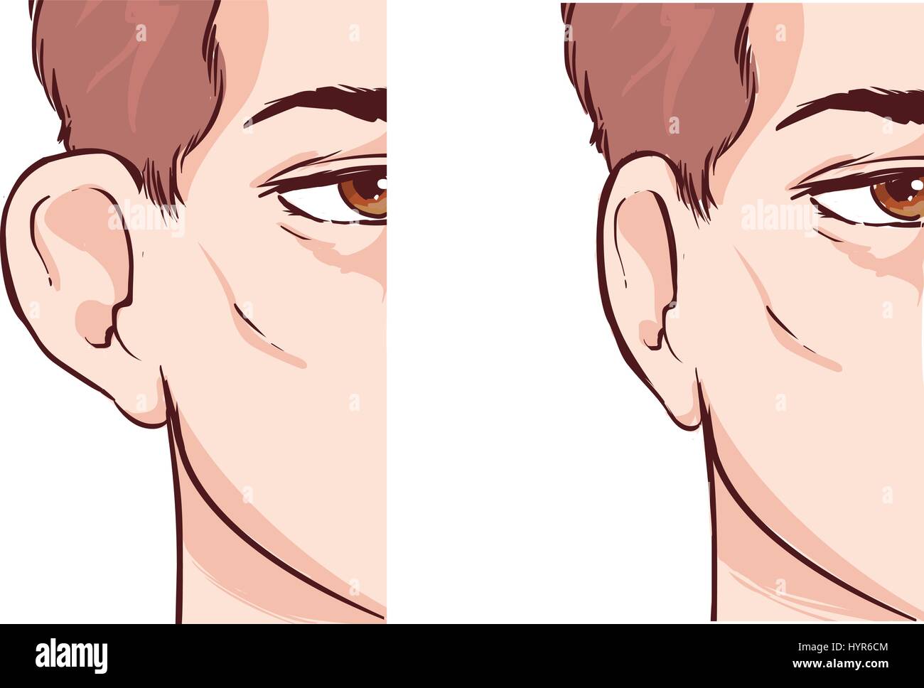 white backround Vector illustration of a Ear Pinnin Otoplasty Stock ...