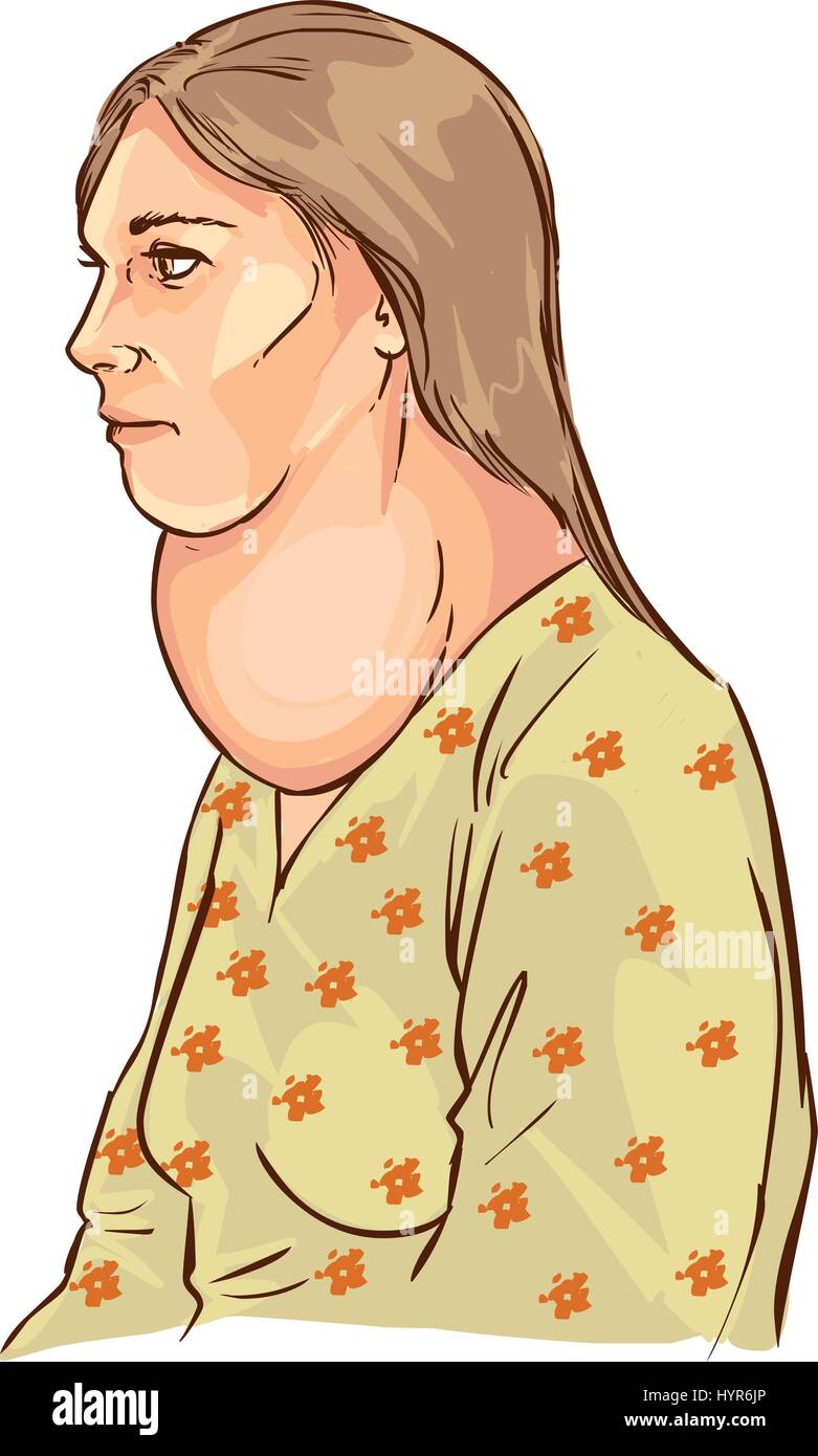 Goiter hi-res stock photography and images - Alamy