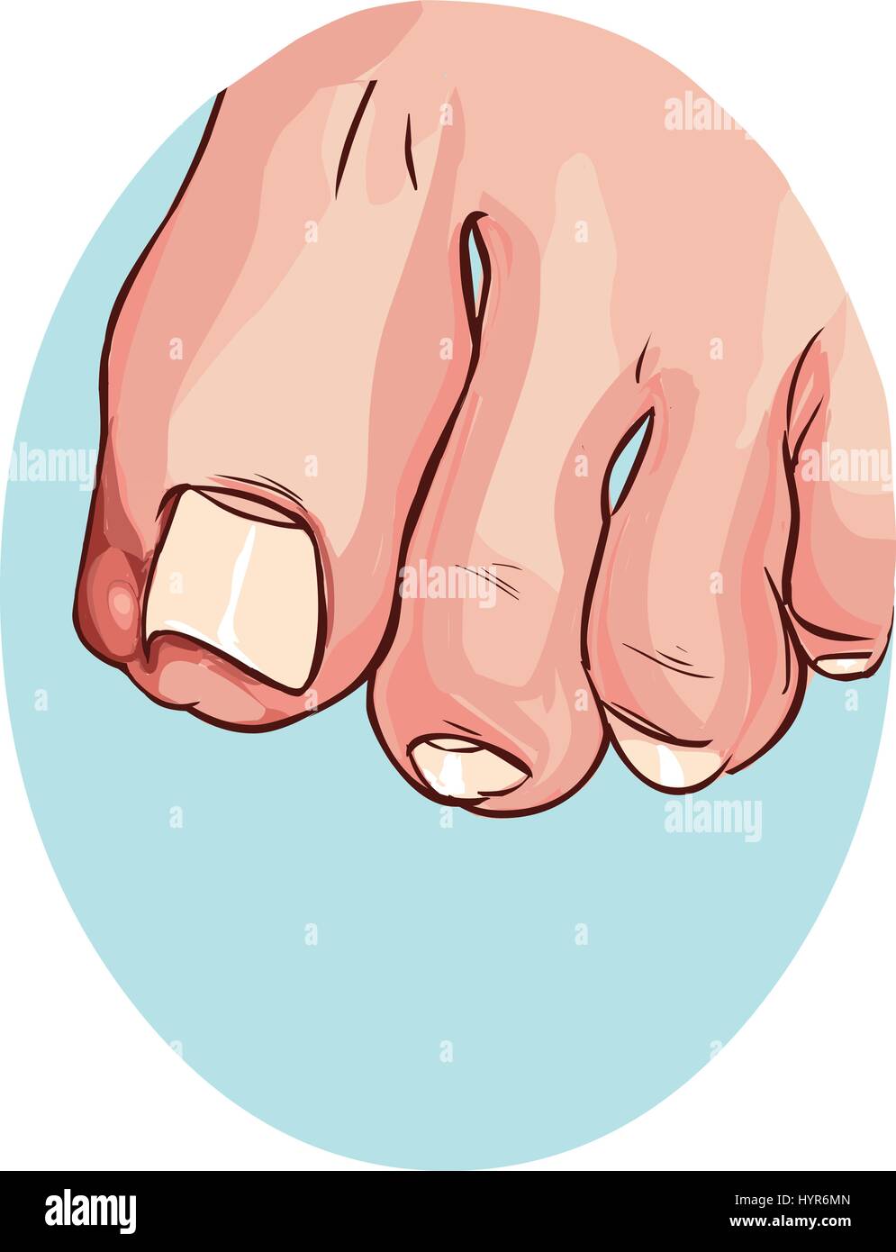 Ingrown toenail hi-res stock photography and images - Alamy