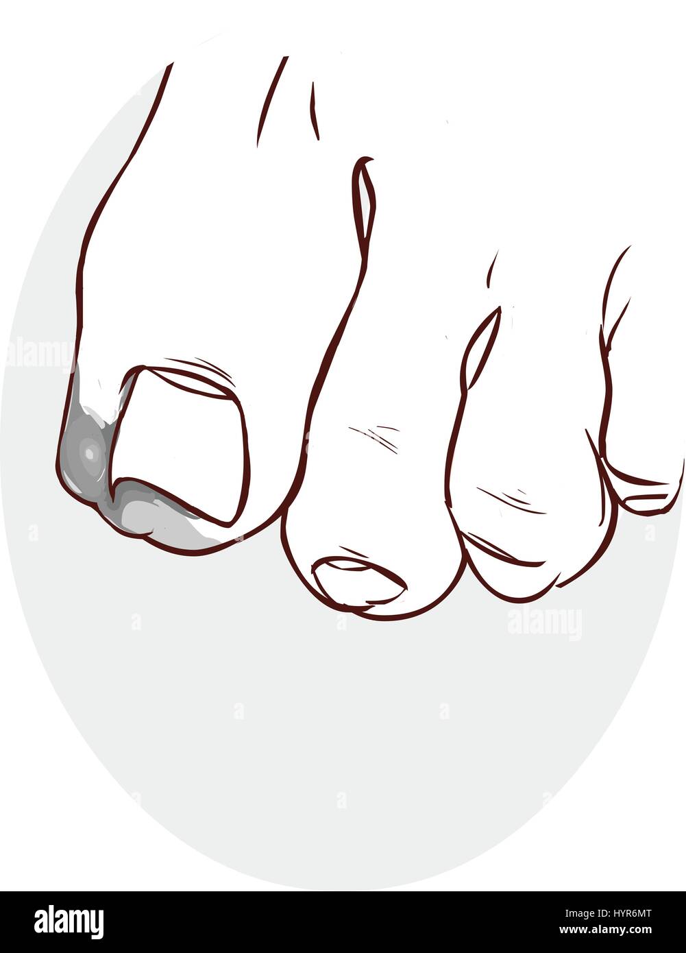 Ingrown toenails hi-res stock photography and images - Alamy