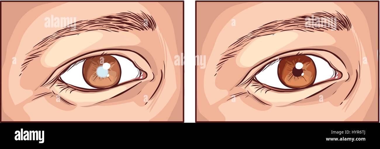 detailed vector medical illustration of a cataract Stock Vector Image ...