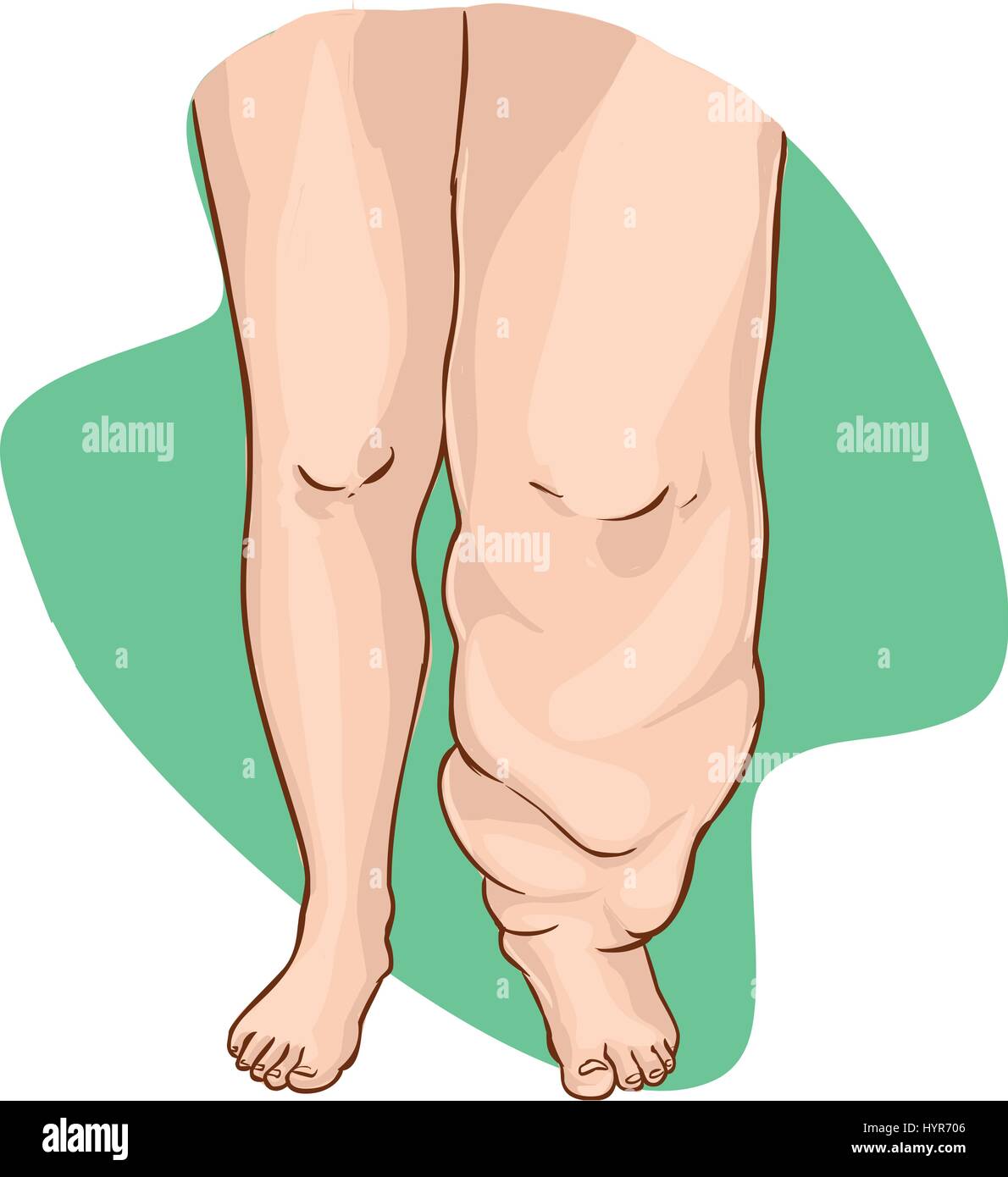 Elephantiasis hi-res stock photography and images - Alamy