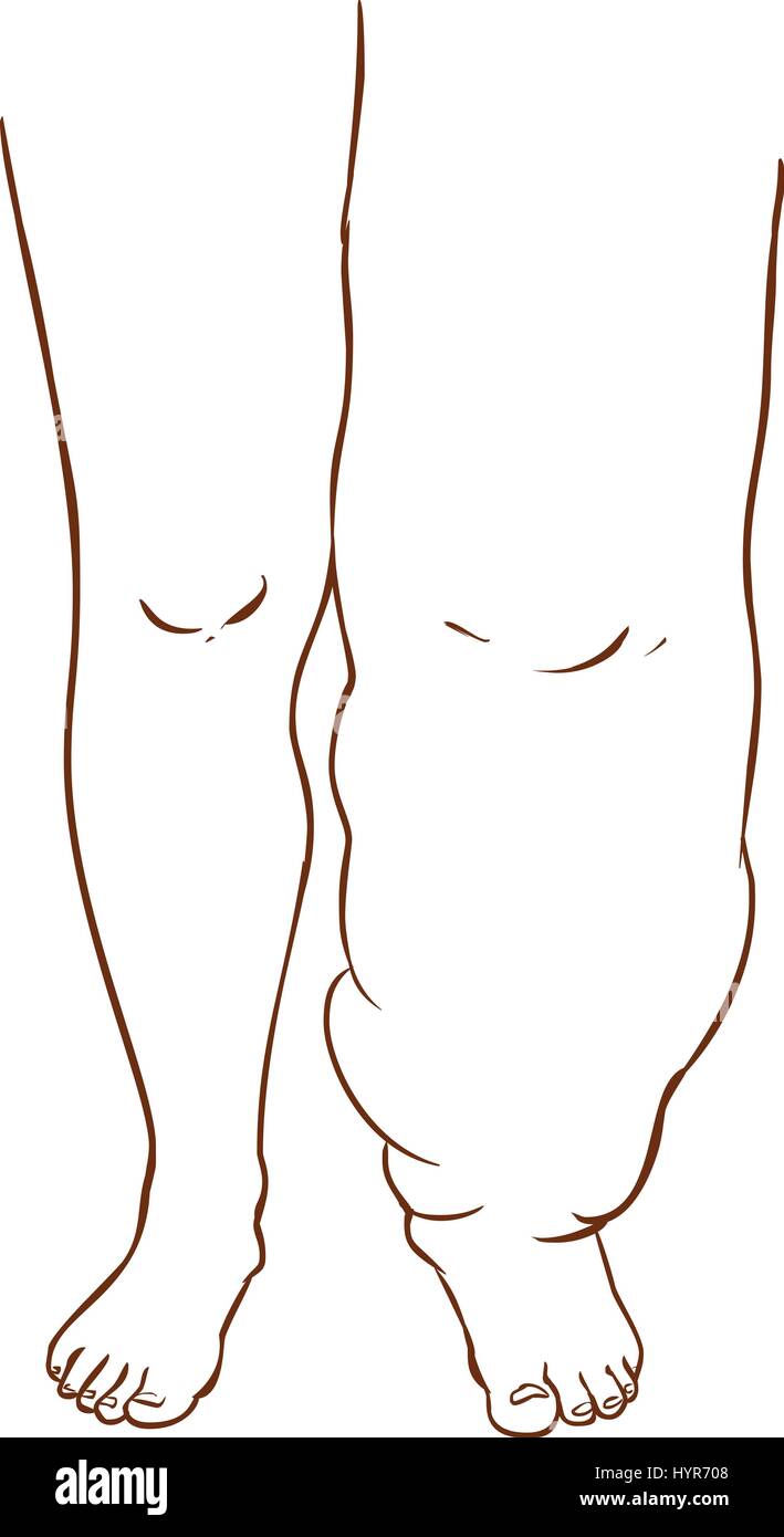 Elephantiasis hi-res stock photography and images - Alamy