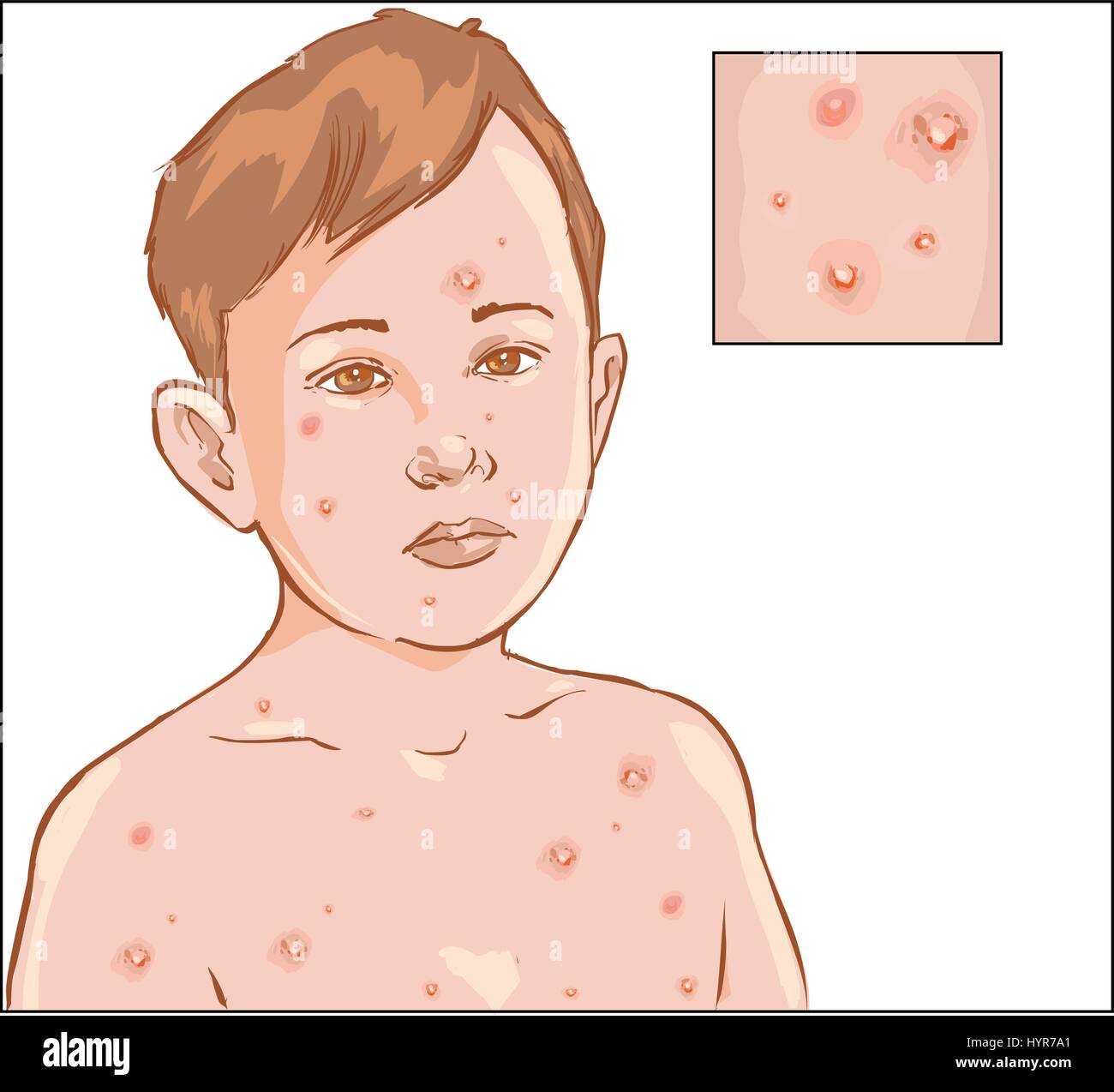 Chicken pox hi-res stock photography and images - Alamy