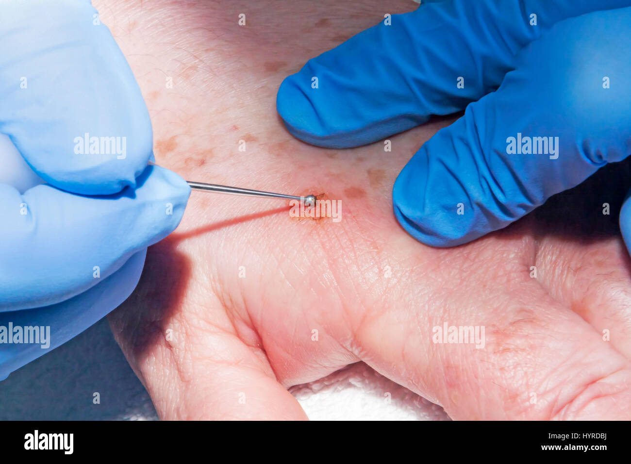 Electrocoagulation hi-res stock photography and images - Alamy