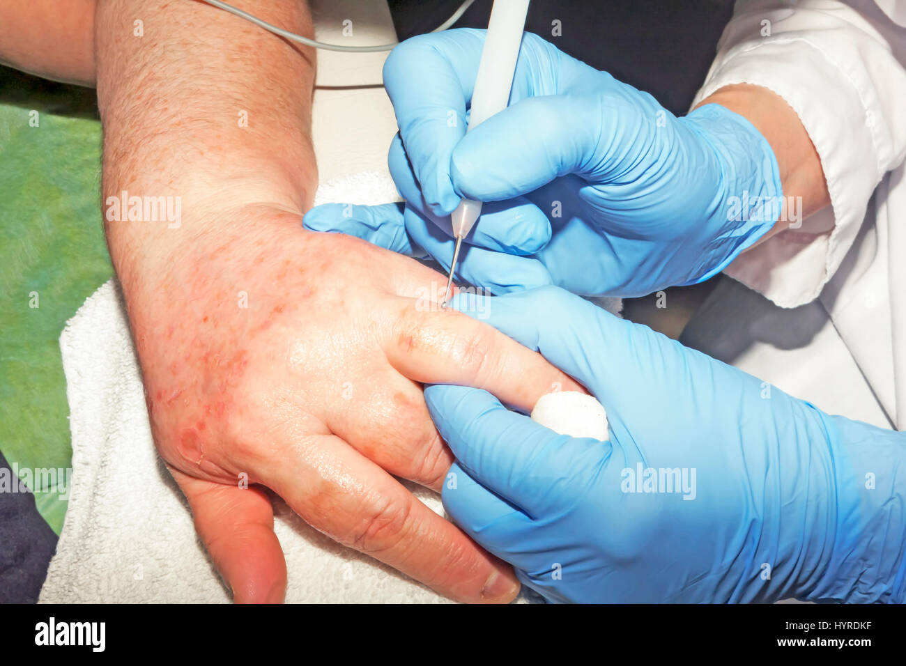 Electrocoagulation High Resolution Stock Photography and Images - Alamy