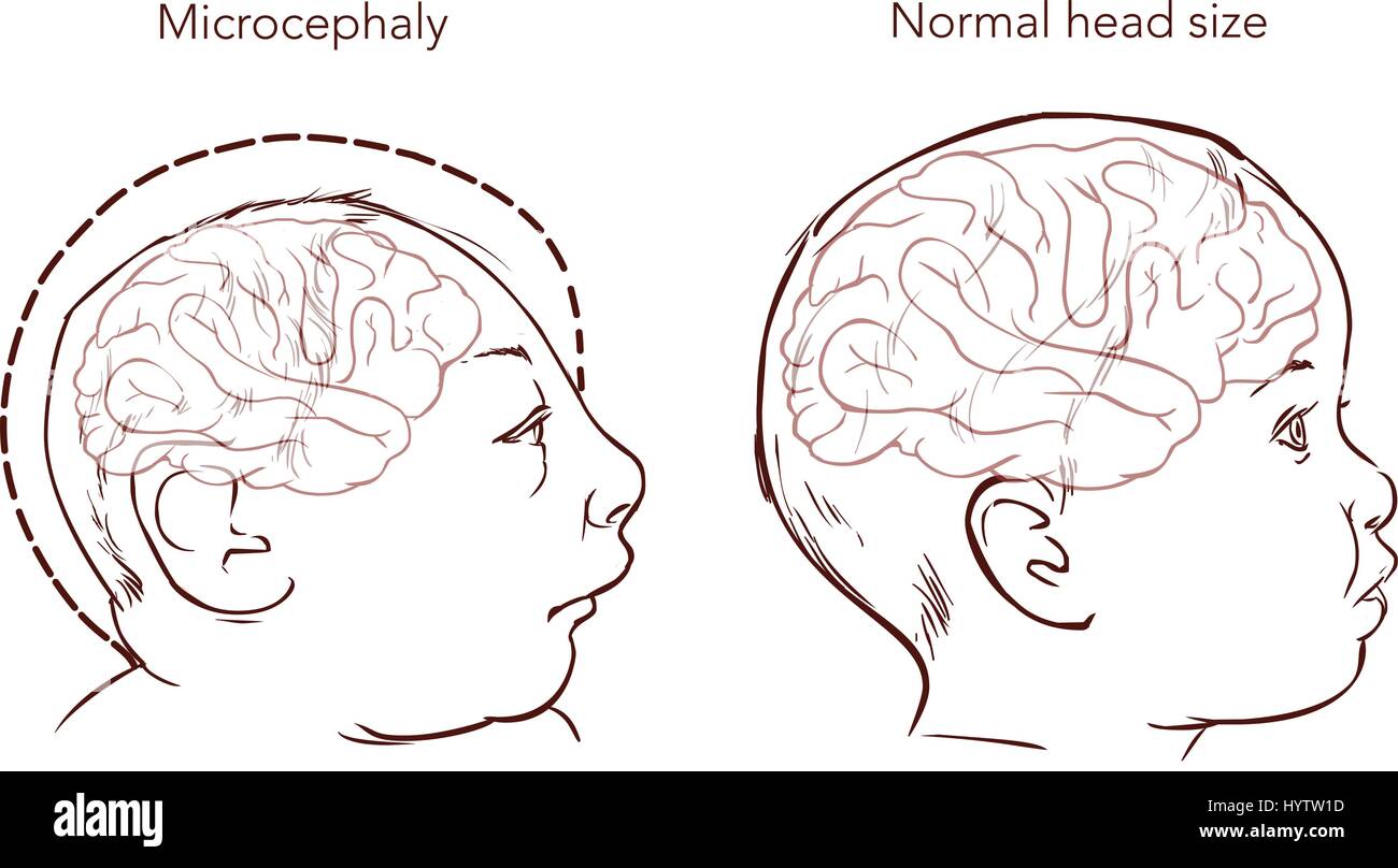 Small Head Disease